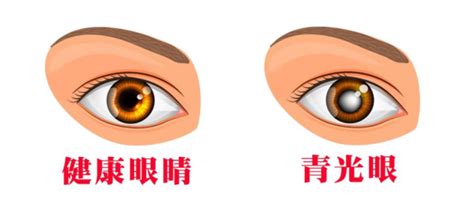 第二大致盲性眼病青光眼您了解吗