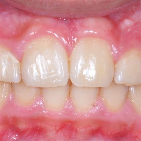 Intraoral View After Treatment Frontal View Download Scientific Diagram