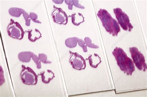 Cervical Biopsy Slides Stock Image C0029717 Science Photo Library