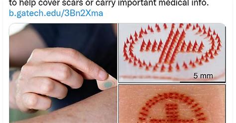 Microneedle Patch Tattoos Album On Imgur