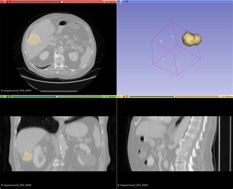 Nour Islam Mokhtari On Linkedin Currently Doing Some Experimentation With Nnunetv2 Below You