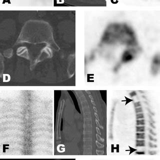 Patient Characteristics ECOG Eastern Cooperative Oncology Group Score Download Table