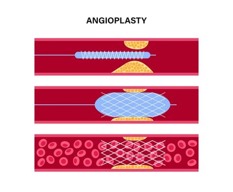 Angioplasty Cardiac Stent Stock Vector Image By ©pikovit 485728012