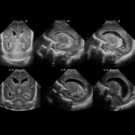 Intraventricular Hemorrhage Of The Newborn Pacs