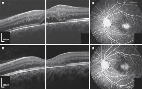 Intravitreous Ranibizumab As Treatment For Macular Telangiectasia Type