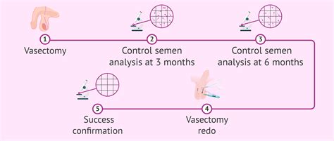 Re Doing Vasectomy After Unsuccessful Vasectomy