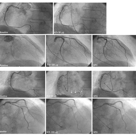 Coronary Angiograms During The First And Second Spasm Provocation Test