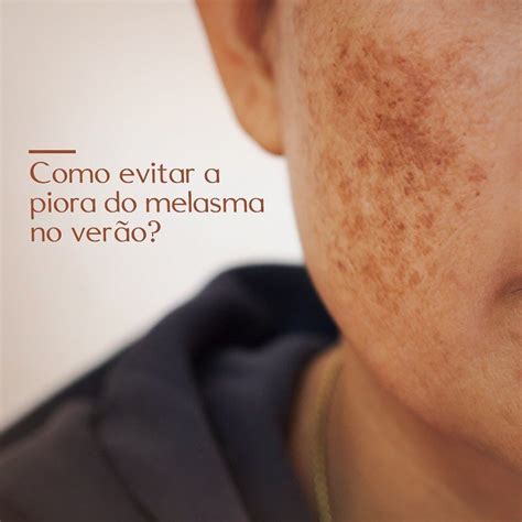 Tratamentos Para Manchas Na Pele Grupo Caru Moreno
