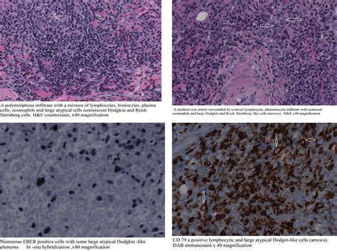 The Histological And Immunohistochemical Features Of The Ulcer