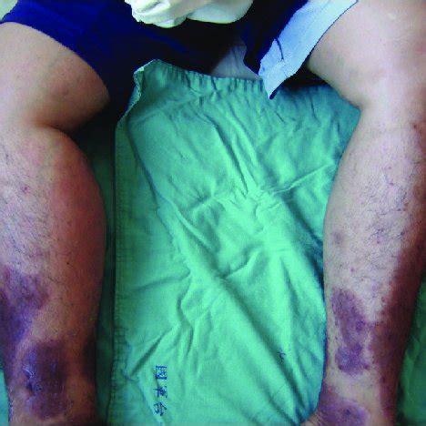 Contrast Enhanced Axial Computed Tomography Ct Scan Of The Right Knee