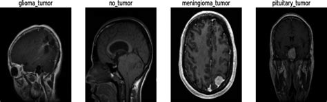 Advancing Brain Tumor Detection Harnessing The Swin Transformers Power For Accurate