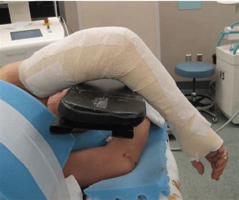Clavicle Fractures Open Reduction And Internal Fixation