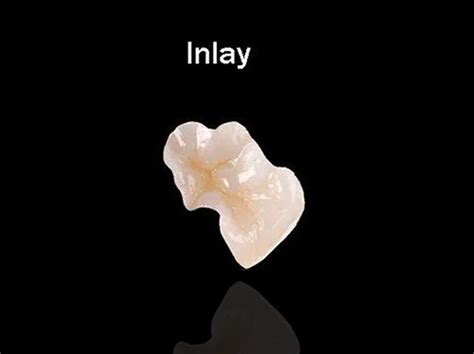 Incrustación Ceramica Ideal Dental