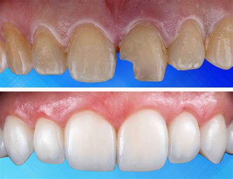 Gapped Teeth Treatment For Space Between Teeth Toronto Dental Clinic