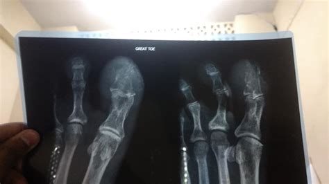 A Case Of Left Lower Limb Ischemia Post Op Status Where Osteomyelitis And Gangrene Of The Left