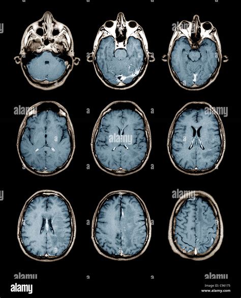 Normal Brain MRI Scans Stock Photo Alamy