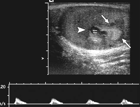 Testicular Hematoma Ultrasound Ultrasound And Color Doppler Videos