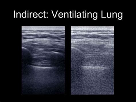 Ultrasound Confirmation Of Ett Placement Ppt