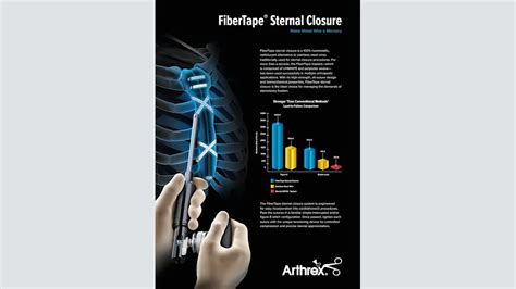 Arthrex Fibertape® Sternal Closure System