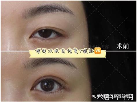 【埋线双眼皮修复提肌术后1个半月】 知乎