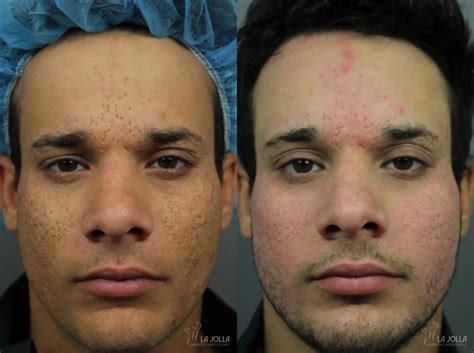 Acne Scars Before And After Gallery Patient 19