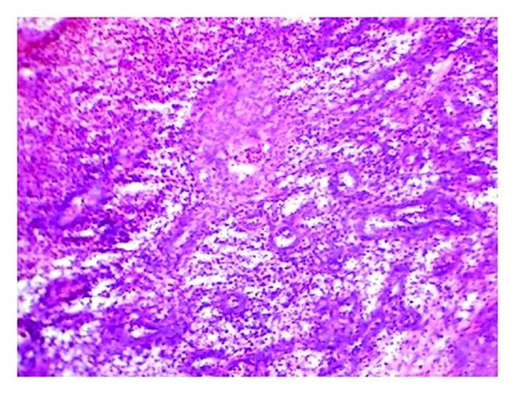 A Histopathological Picture Showing Sheets Of Epitheliod Cells