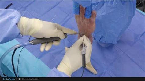 Scapholunate Ligament Injuries Arthroscopic Volar Scapholunate