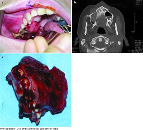 1 A B C Osteosarcoma Of The Right Posterior Maxilla Photograph Download Scientific Diagram
