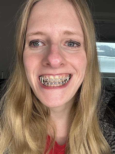 Ive Had My Braces For One Year Today 😊 Rbraces