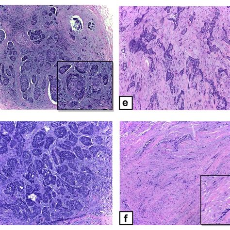 Histomorphological Characteristics Of Subtypes And Variants Of Bcc A