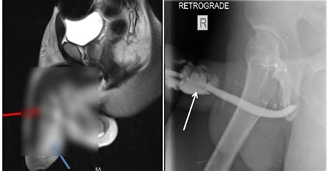 Click And Youre Done Tanzanian Received A Triple Fracture Of The Penis During Sex 2 Photos