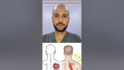 اسباب وعلاج الابهر الابهر والكتف واعلي الظهر Youtube