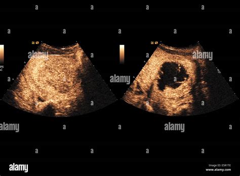 Fibrome utérin Banque de photographies et dimages à haute résolution Alamy