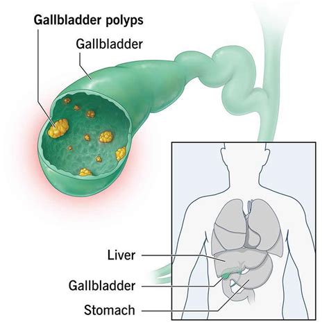 Gallbladder Polyps Symptoms Causes And What It Is Wockr