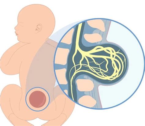 اسپینا بیفیدا مرکز تصویربرداری پزشکی دکتر قائمیان