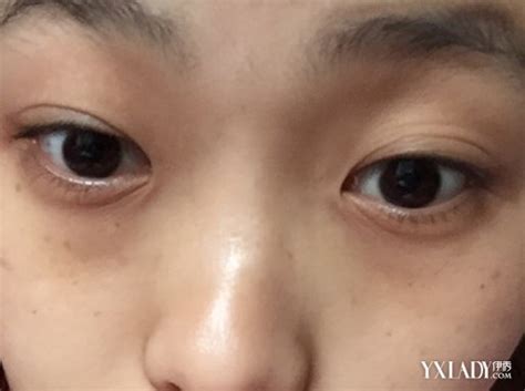 【图】长期黑眼圈怎么办 盘点该症状的5大警报及应对方法长期黑眼圈伊秀美容网