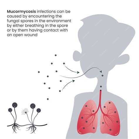 Infection Fongique Noire De Mucormycose Dans Les Poumons Par Les Spores