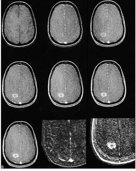 Figure 1 From Correlation With Histologic Grade Using Dynamic Contrast