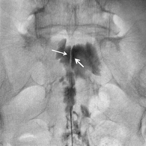Figure 3 From Unexpected Contrast Filling During Fluoroscopy Guided