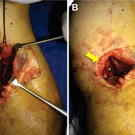 Posteromedial Approach With The Patient Prone A The Bone Block Of The