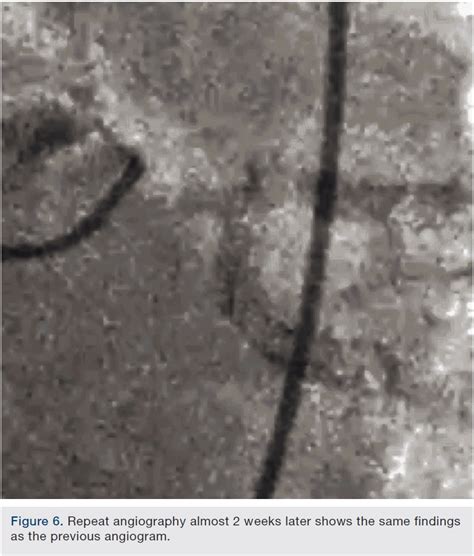 Coronary Atherectomy Part Iii Of Iii Orbital Atherectomy