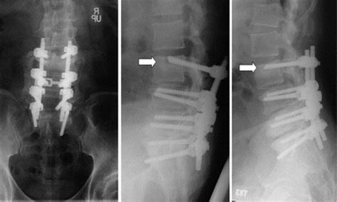 Revision Strategies For Lumbar Pseudarthrosis Orthopedic Clinics