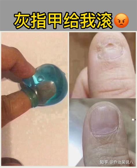 治疗灰指甲是内服药好还是修脚好？ 知乎