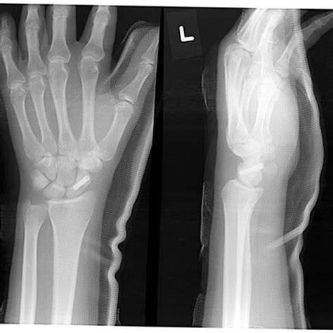 What Is A Three Phase Bone Scan Healthy Living