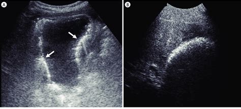 Emphysematous Cholecystitis Ultrasound