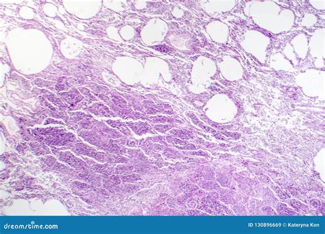 Histopathology Of Interstitial Pneumonia Stock Image Image Of