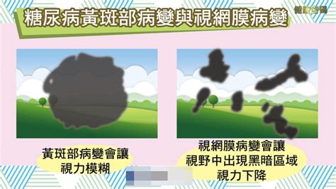 糖尿病患者如何保護眼睛？血糖太高很傷眼，保護眼睛這樣做！ Youtube