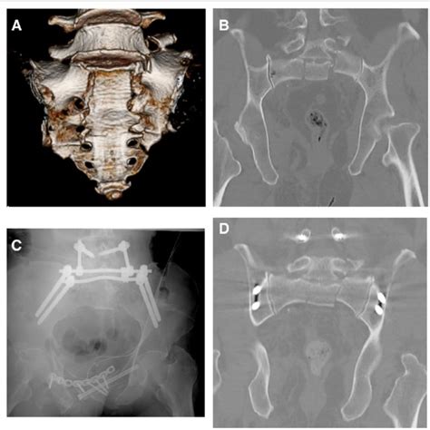 Radiculography Of The Left L5 Nerve Root Performed With A Contrast