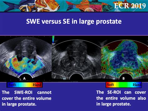 Comparison Between Swe A And Se B In An Hypertrophic Prostate Due