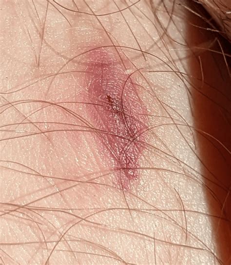 Mole Bleeding And Peeling Off Bleeding Mole Should You Worry Dfqmo